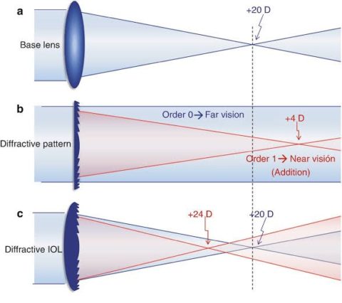 Near Vision after Cataract Surgery with Multifocal Intraocular Lens ...
