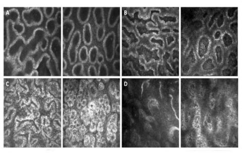 Meibomian Gland Dysfunction (MGD) with recent advanced technologies ...