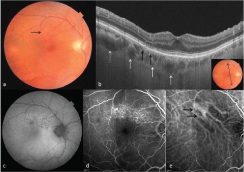 The Pachychoroid Spectrum - Vision Science Academy