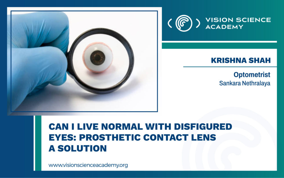 Can I Live Normal With Disfigured Eyes: Prosthetic Contact Lens A ...