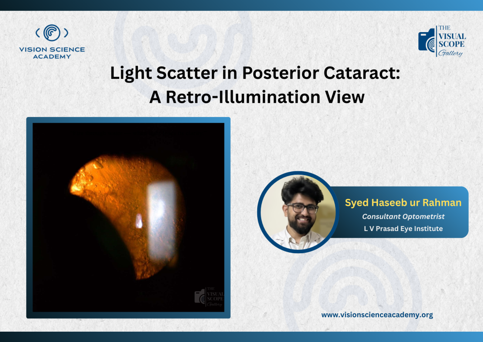 Light Scatter in Posterior Cataract: A Retro-Illumination View - Vision ...
